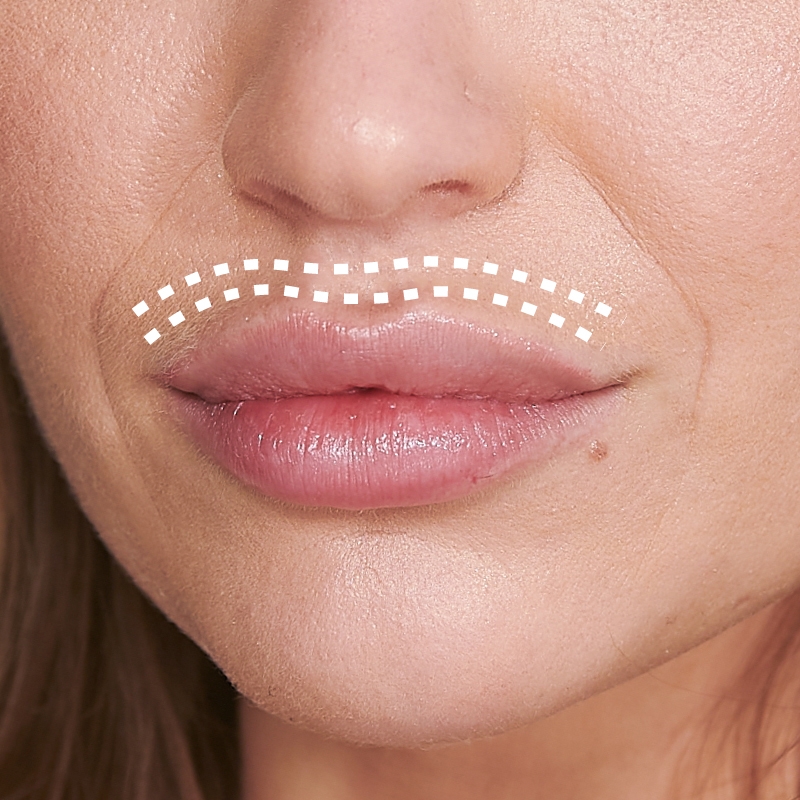 Results Laser Clinic, Australia's No.1 choice for laser hair removal ...